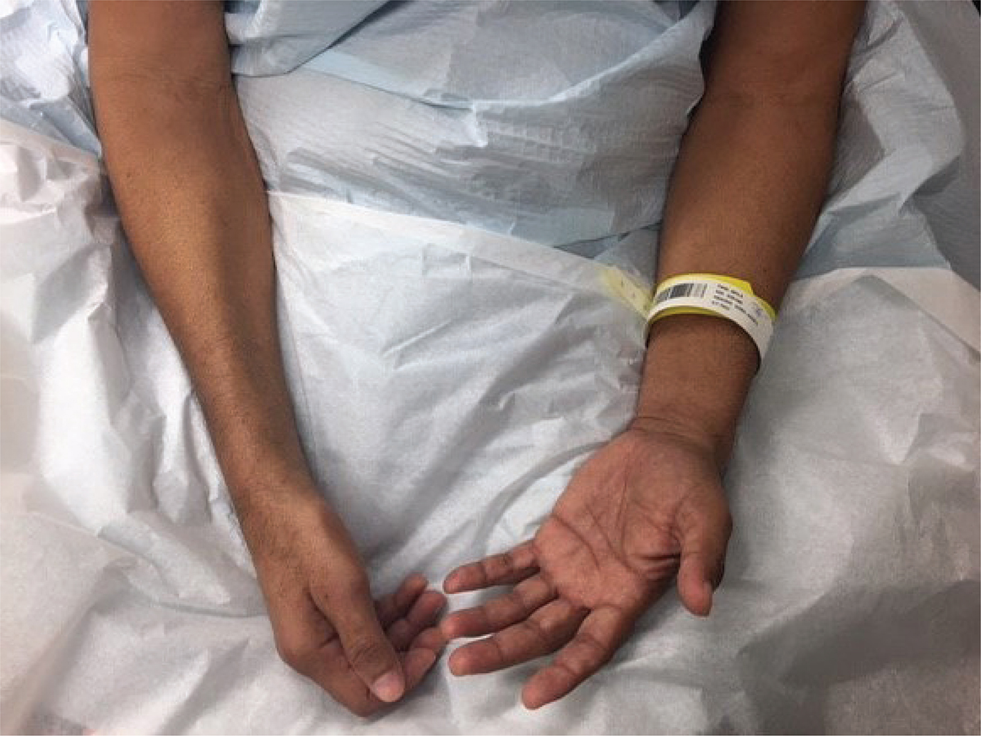 Muscle Atrophy Als